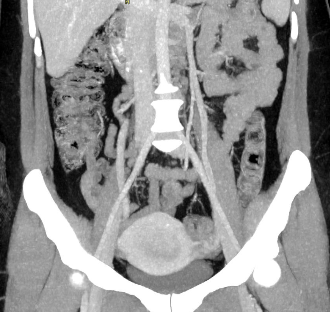 Varices pelviennes - Azuradiologie